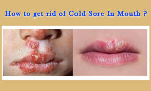 How To Get Rid Of Cold Sore In Mouth